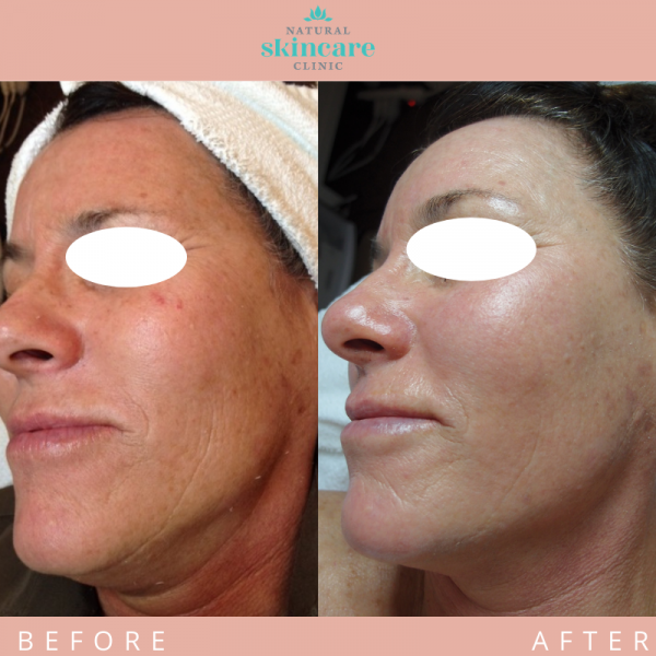 Anti-Aging Treatments Denver | Natural Skincare Clinic