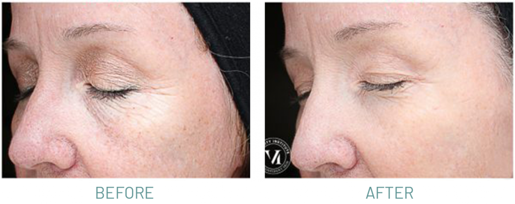 VI Peel Denver | $50 Off and Complimentary Consult