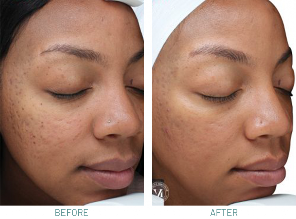 VI Peel Denver | $50 Off and Complimentary Consult