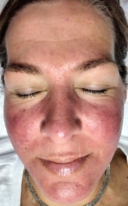Rosacea Treatment - Natural Skincare Clinic